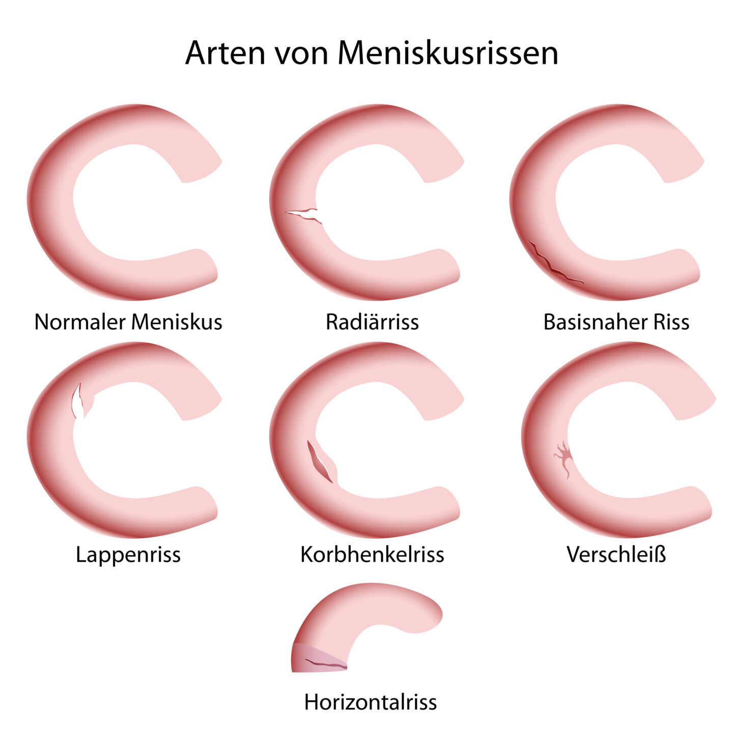 Das bedeutet die Diagnose Meniskusriss